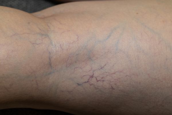 Leg Veins - The Centre for Dermatology